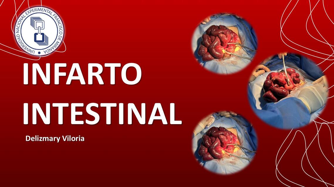 INFARTO INTESTINAL | Deliz | uDocz