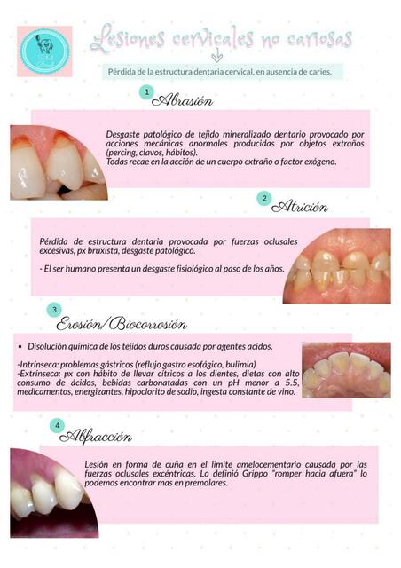 Lesiones Cervicales No Cariosas Salud Bucal Udocz