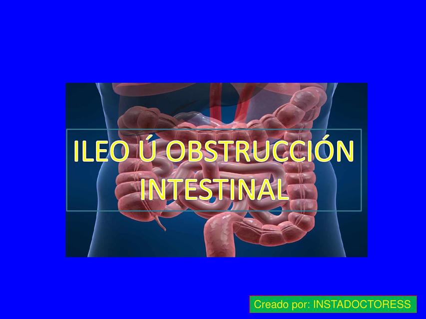 ILEO Ú OBSTRUCCIÓN | Anatomía | Obstrucción intestinal | uDocz