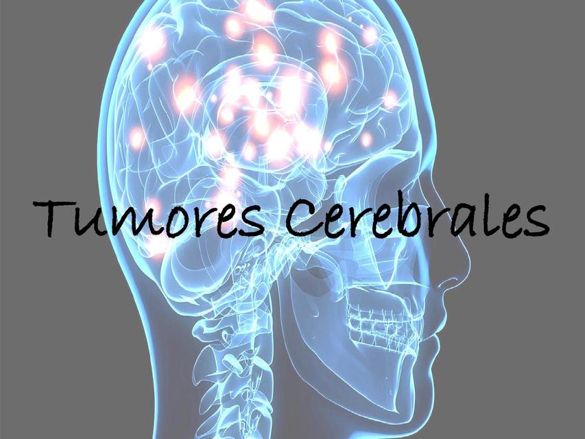 Tumores Cerebrales | Alessandra | uDocz