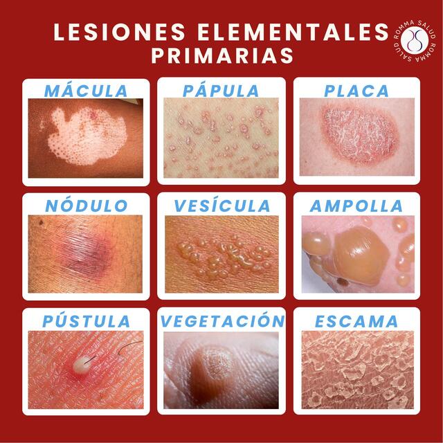 Lesiones elementales primarias y secundarias | ROMMA SALUD | uDocz