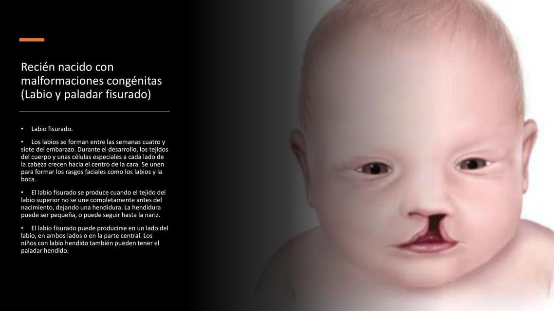 Recién nacido con malformaciones congénitas | Luz Belén | uDocz