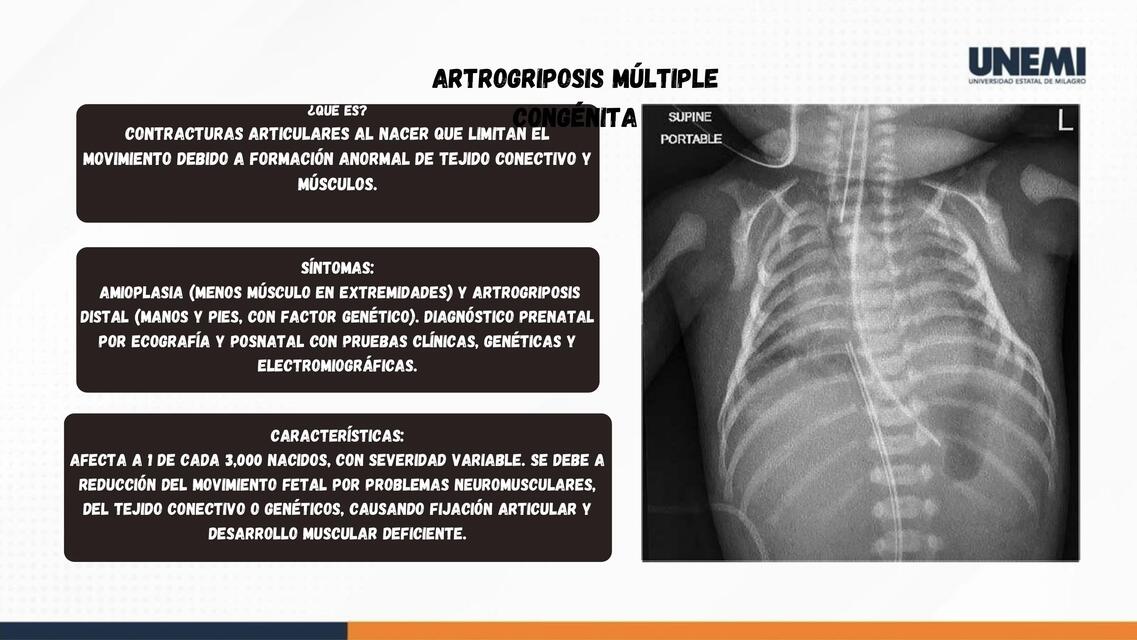 Artrogriposis Múltiple Congénita Qué es Condición | JOEL | uDocz
