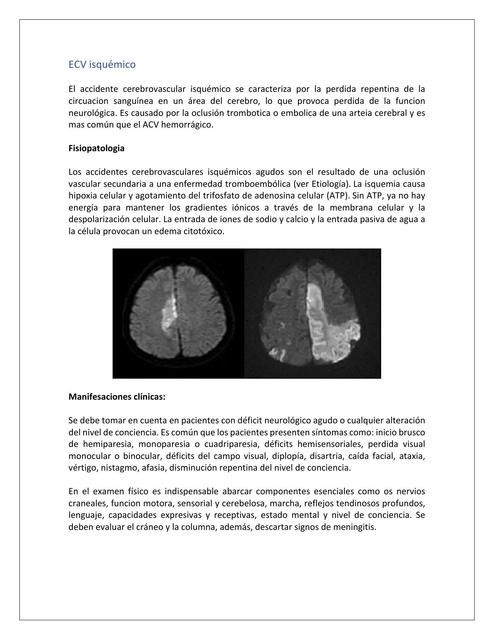 Evento Cerebrovascular Isquémico | Daniela Gómez | uDocz