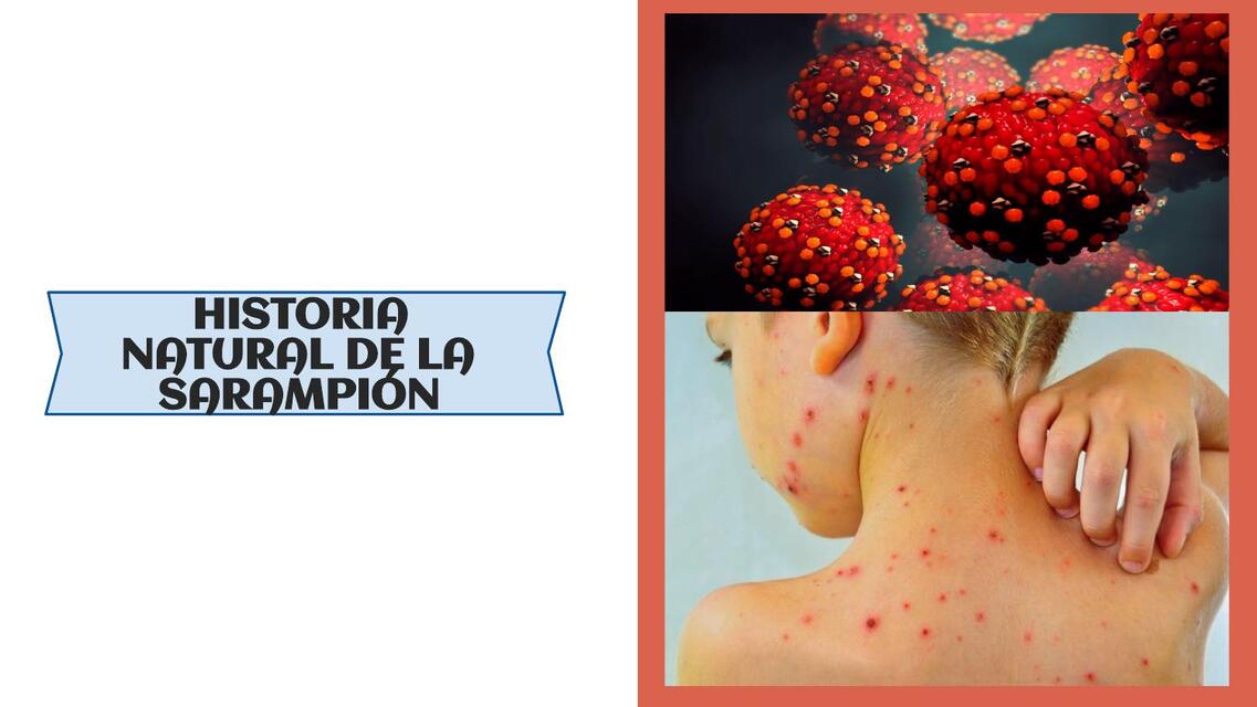 HISTORIA NATURAL DE LA SARAMPIÓN | katty Ramirez | uDocz