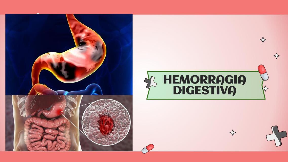 HEMORRAGIA DIGESTIVA | katty Ramirez | uDocz