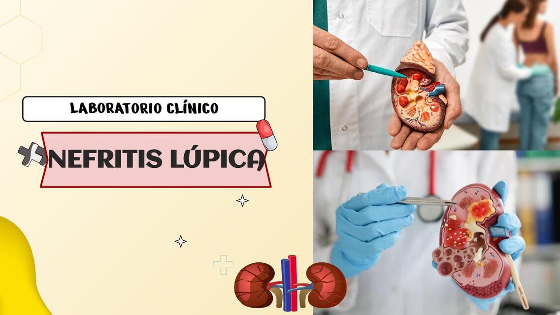 NEFRITIS LÚPICA | katty Ramirez | uDocz