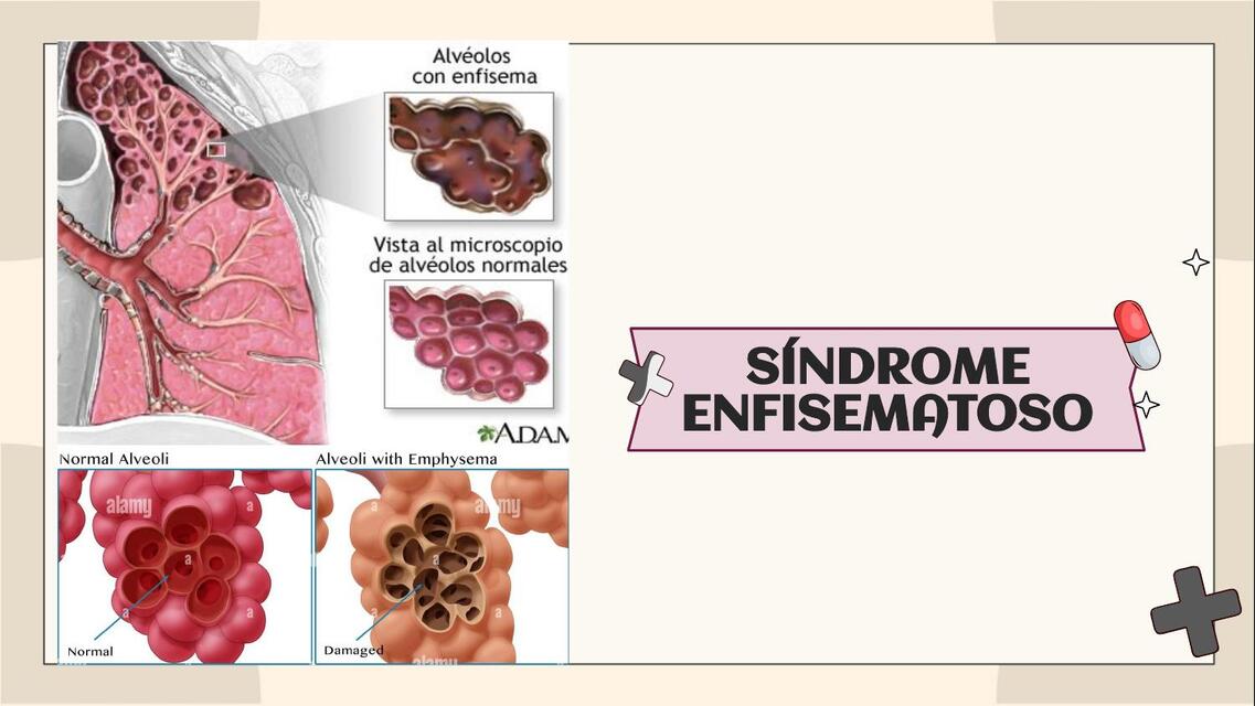 SÍNDROME ENFISEMATOSO | katty Ramirez | uDocz