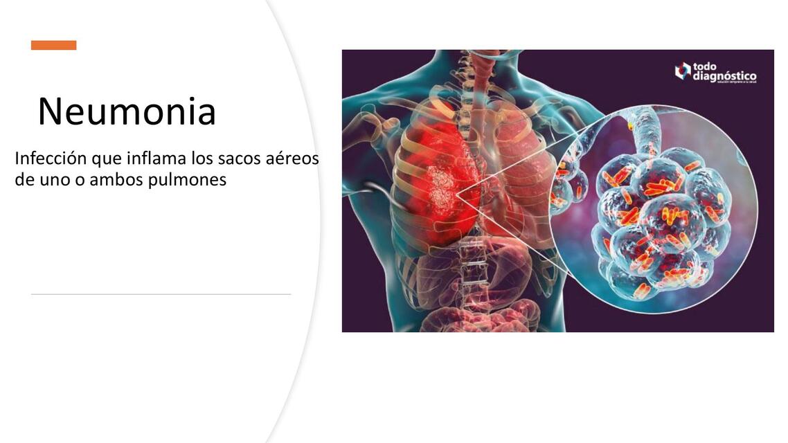 Neumonia | Daniel | uDocz