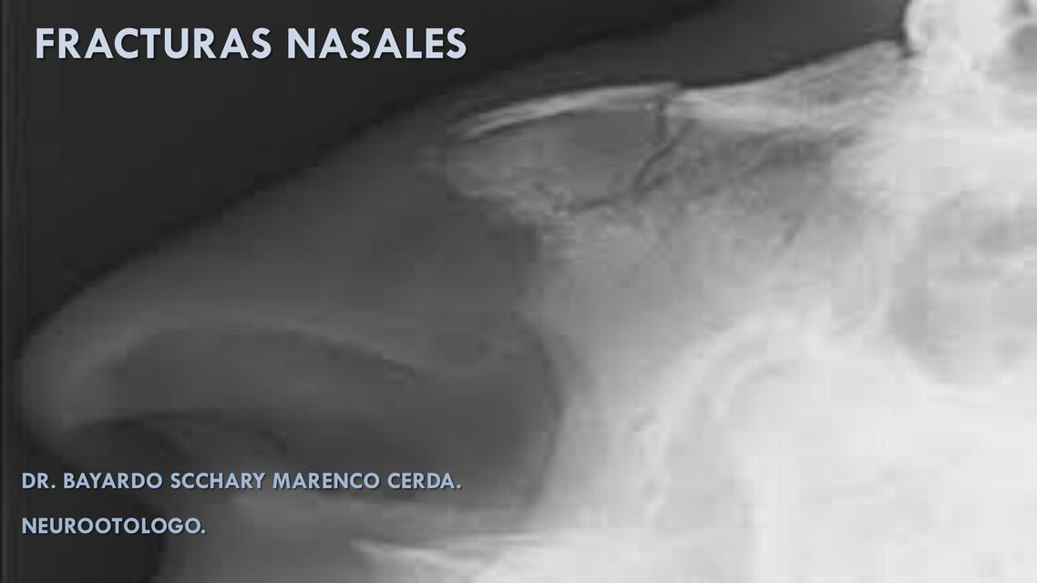 2 FRACTURAS NASALES | walkiria | uDocz