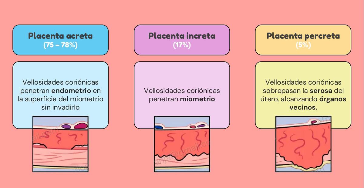 Placenta acreta increta y percreta | Javier Rios | uDocz