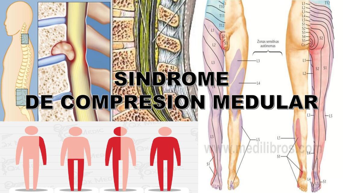 SINDROME DE COMPRESION MEDULAR | Julian Torrez | uDocz