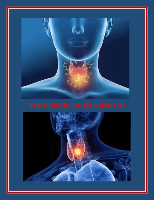 TIROIDISMO DE HASHIMOTO | Ezequiel | uDocz