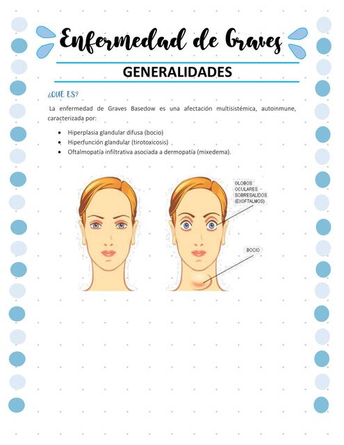 Enfermedad de Graves | Zoe Mandujano | uDocz