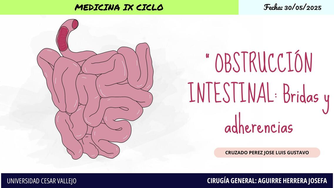 OBSTRUCCIÓN INTESTINAL: Bridas y adherencias | Bruss Cruzado Perez | uDocz