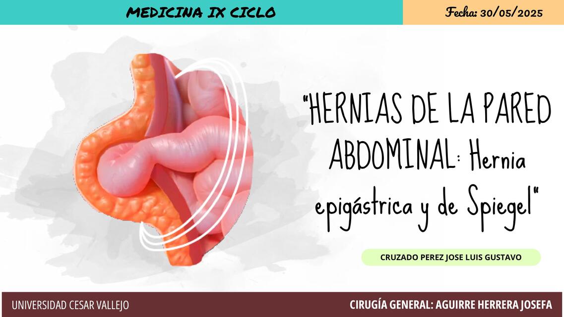 HERNIA EPIGÁSTRICA Y DE SPIEGEL | Luis | uDocz