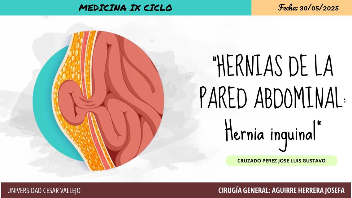 HERNIAS DE LA PARED ABDOMINAL: HERNIA INGUINAL | Luis | uDocz