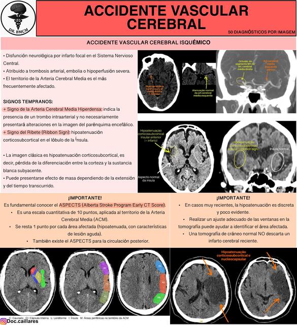 ACCIDENTE VASCULAR CEREBRAL ISQUÉMICO x HEMORRÁGICO | Dr. Boris Moises Caillares Montaño | uDocz