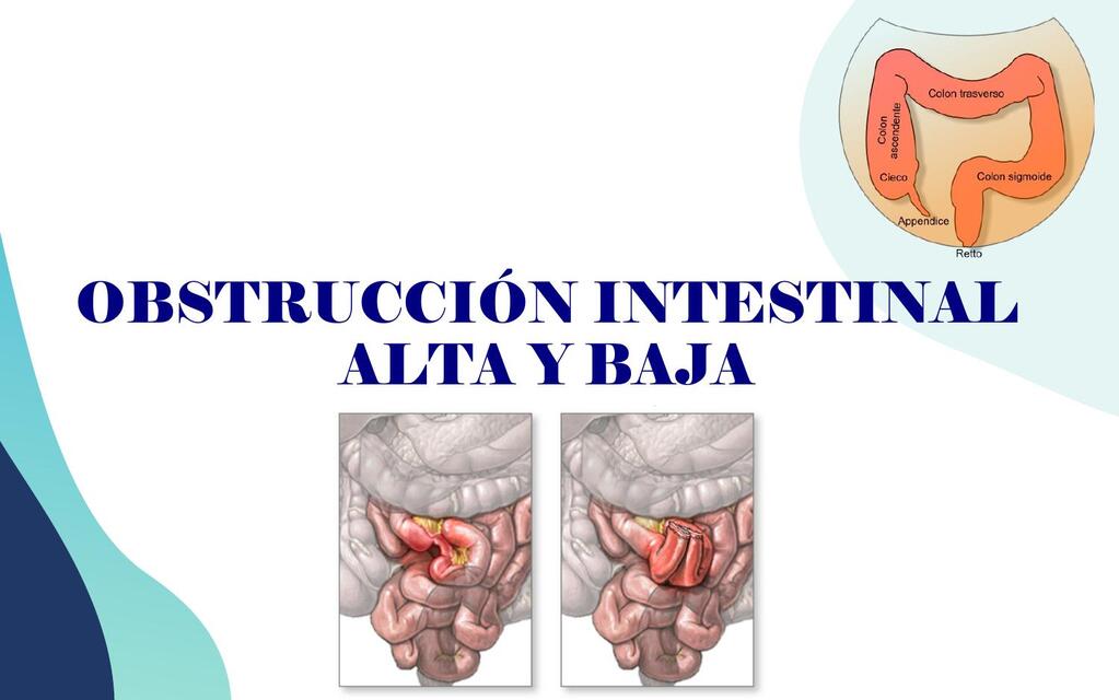 OBSTRUCCIÓN INTESTINAL ALTA Y BAJA JOM | Olazabal | uDocz