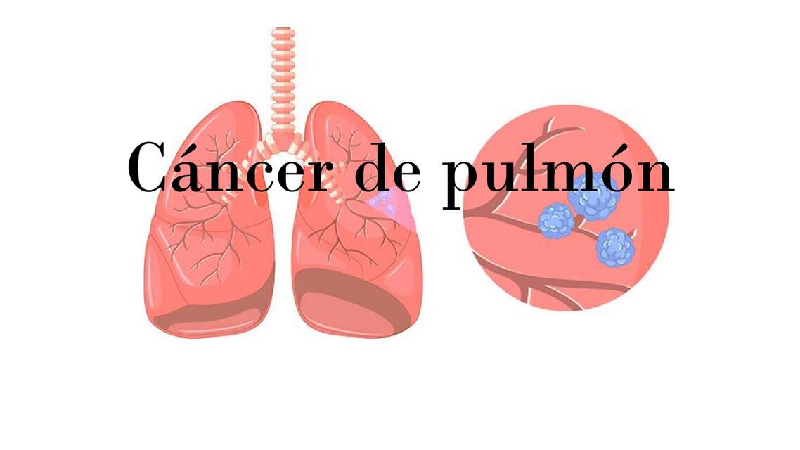 Cancer de pulmon | Montserrat Mateos | uDocz