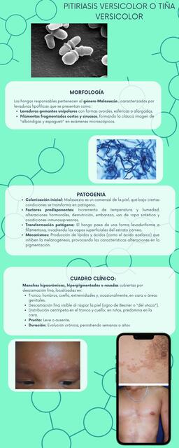PITIRIASIS VERSICOLOR O TIÑA VERSICOLOR | Miguel | uDocz