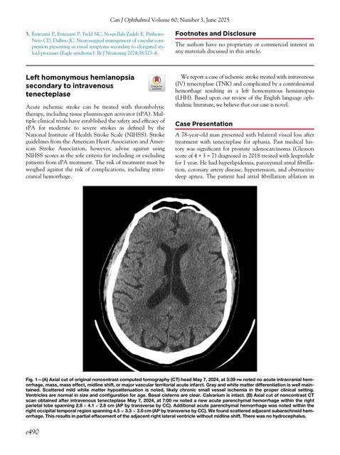 Left homonymous hemianopsia secondary to intraveno | José Gilberto ...