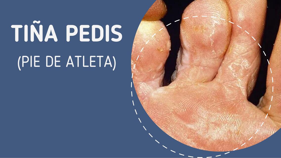 Tiña pedis pie de atleta | valeria | uDocz