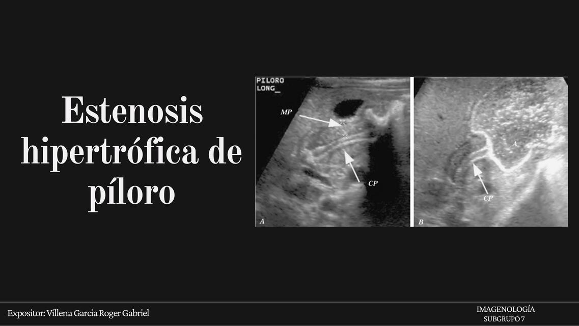 Estenosis Hipertrófica del píloro | ROGER GABRIEL | uDocz
