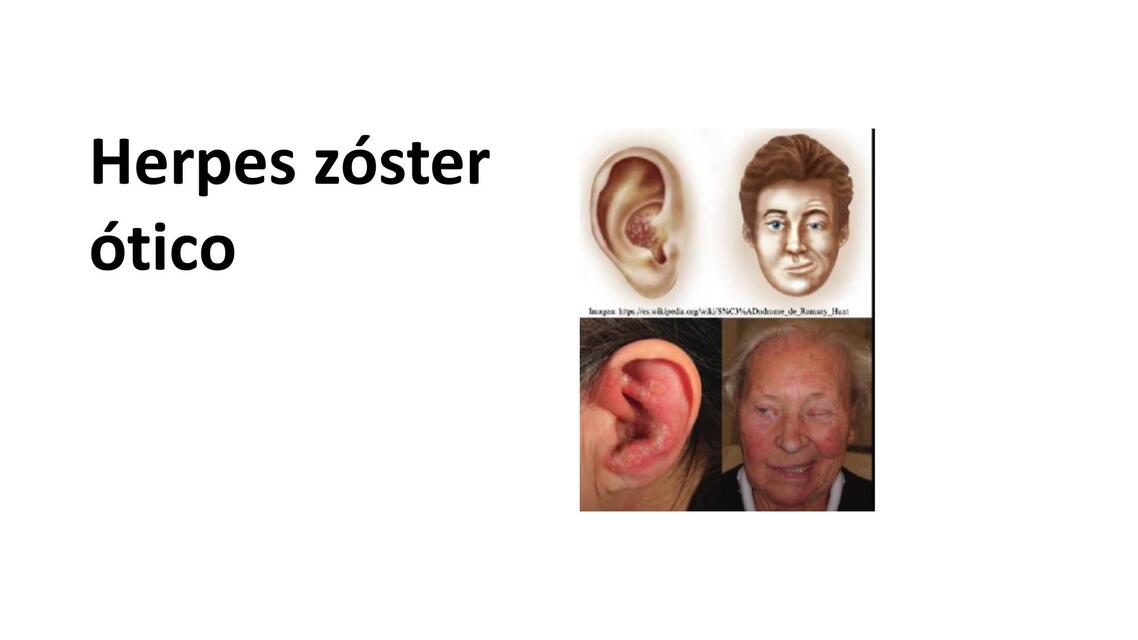 herpes zoster otica | maxi lopez | uDocz