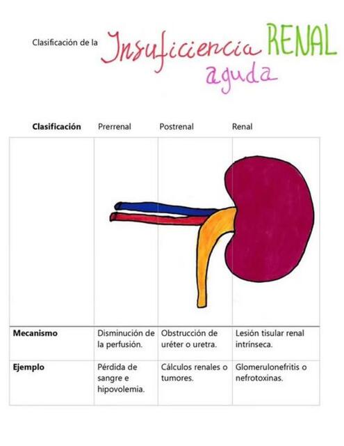 Clasificación de la induficiencia renal aguda | fraii | uDocz
