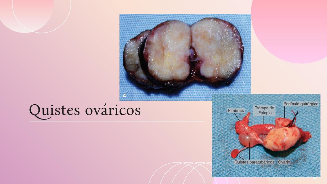 Quistes De Ovario Fer Udocz 9532