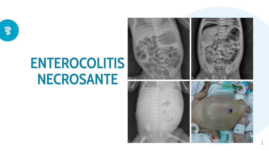 ENTEROCOLITIS NECROTIZANTE | Dopadocs | uDocz
