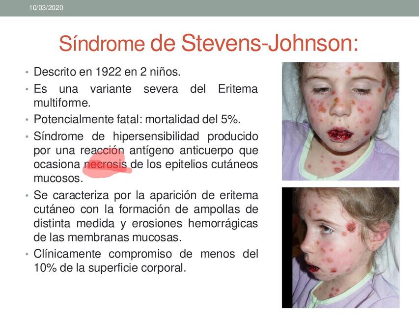 Sindrome de stevens Johnson Definicion | Mizonamédica | uDocz