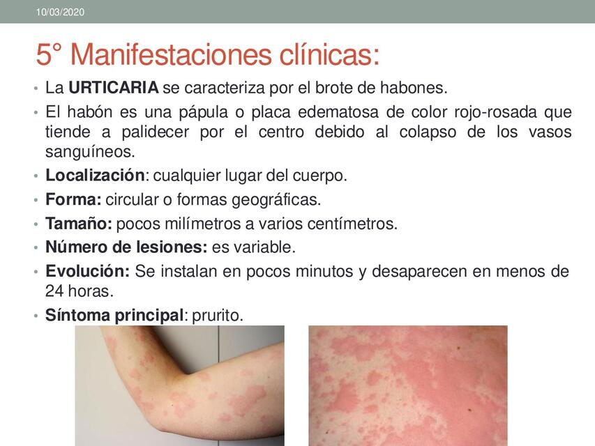 Flashcards de Clinica de la urticaria | Por Mizonamédica | uDocz