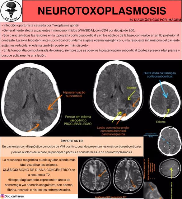 NEUROTOXOPLASMOSIS | Dr. Boris Moises Caillares Montaño | uDocz
