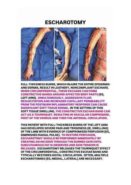 Escharotomy | MEDROMAN | uDocz