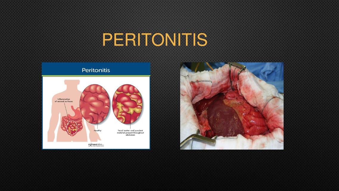 PERITONITIS | Flabia Jacobo | uDocz