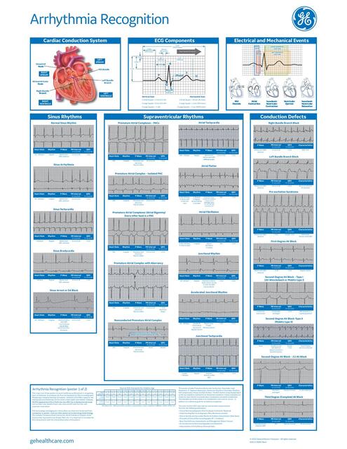 arrhythmia recognition part 1 2aug doc rev2 | Ricardo | uDocz