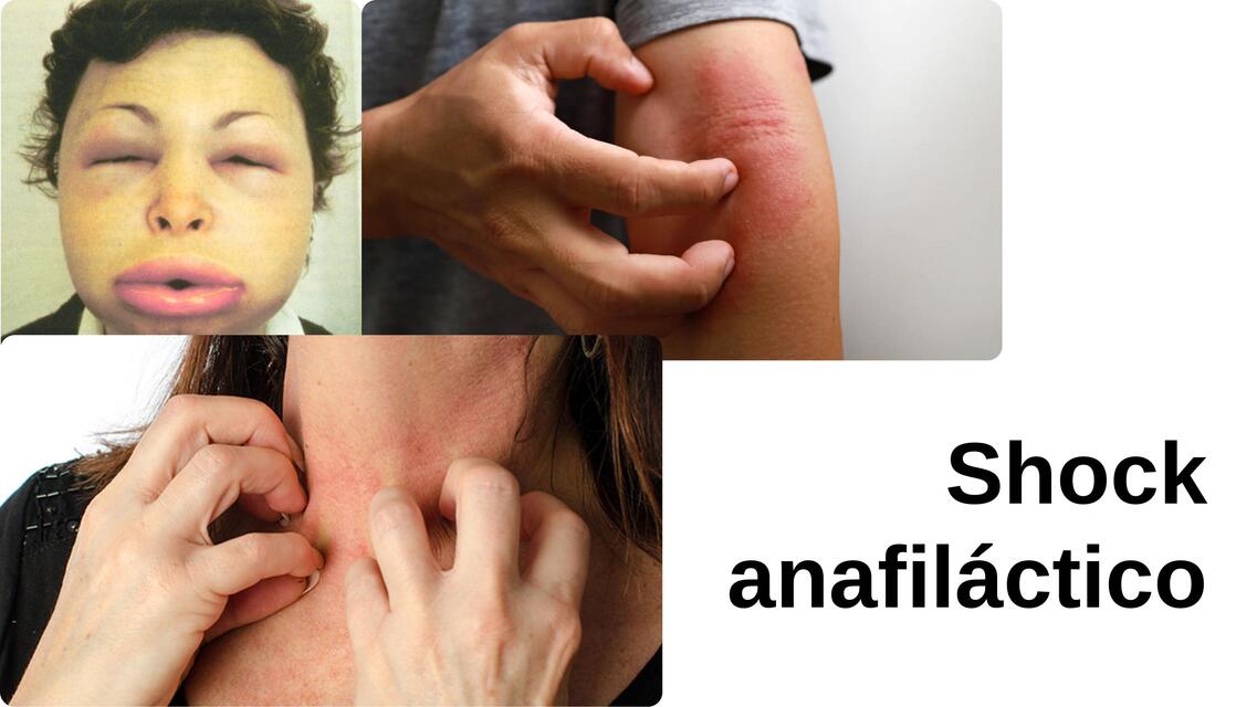 Anafilaxia Shock Escuela Medica Udocz