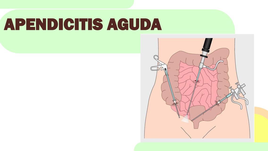 Apendicitis aguda | Maria Fernanda | uDocz
