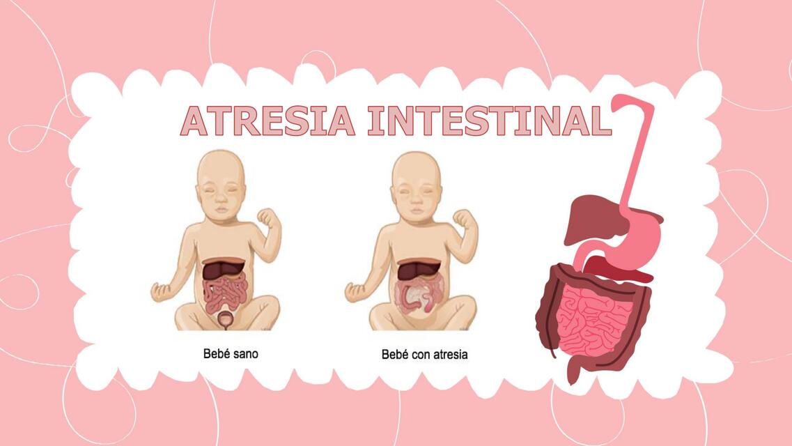Atresia Intestinal | Medicina Óptima | uDocz