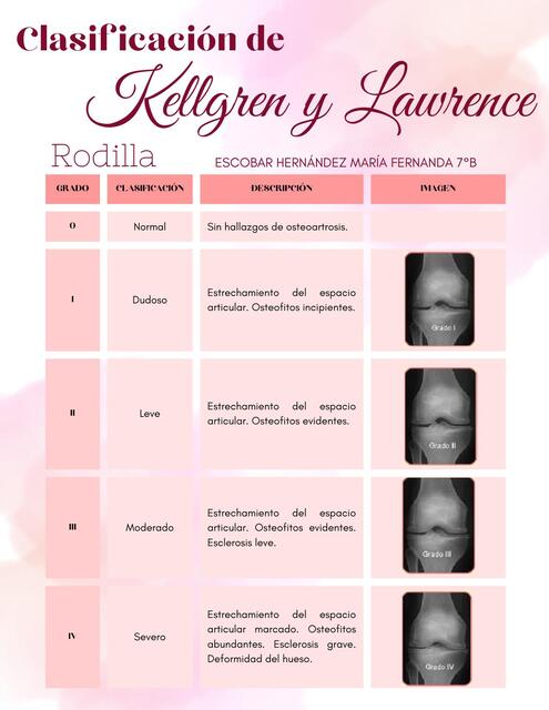 CLASIFICACIÓN DE KELLGREN Y LAWRENCE | Mafer Escobar | uDocz