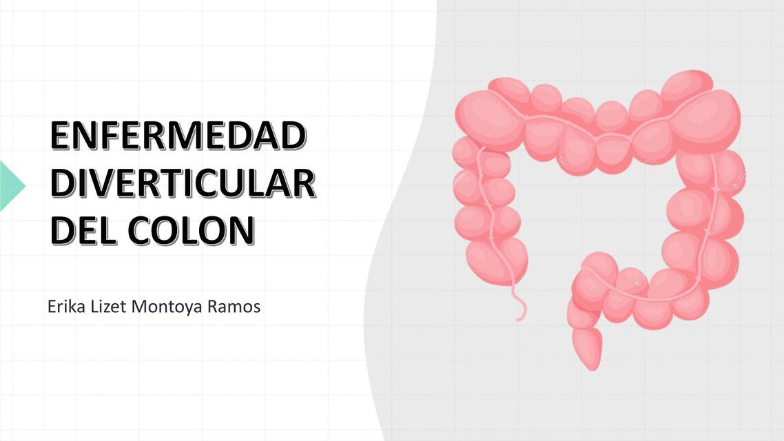 ENFERMEDAD DIVERTICULAR DEL COLON | erika | uDocz