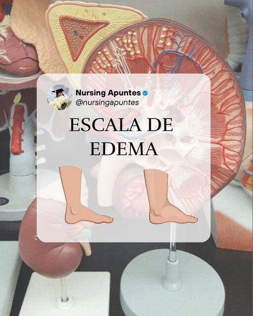 Escala de edema | nursing apuntes | uDocz