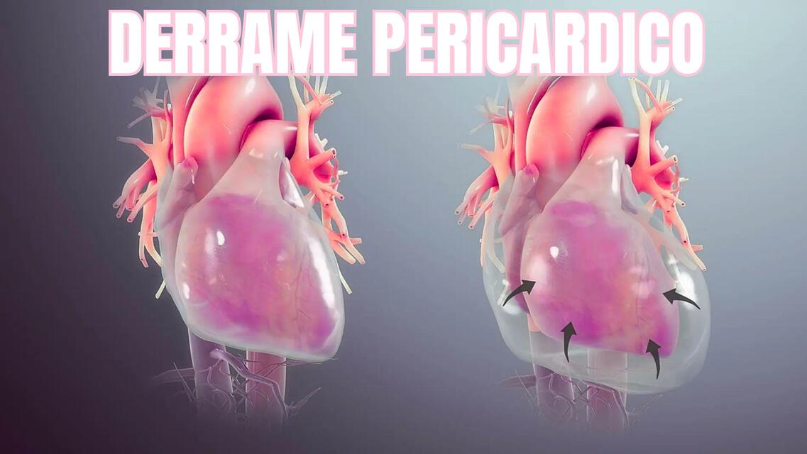 DERRAME PERICARDICO | Maria Monica | uDocz