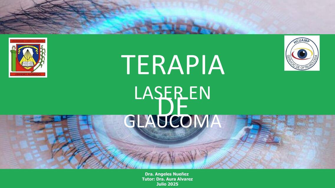 GLAUCOMA laser | sueño Fugaz | uDocz