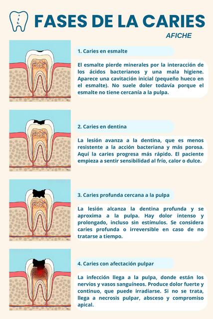 Fases de la caries dental | Odontoinfo 📍🦷 | uDocz