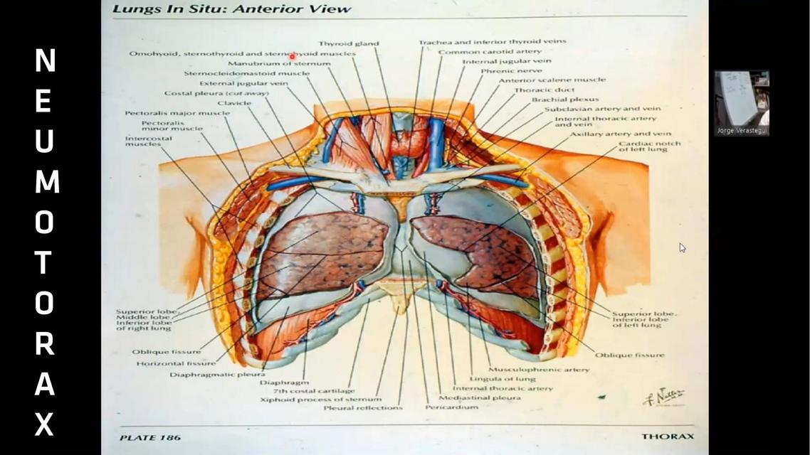 Neumotórax | Julio López | uDocz