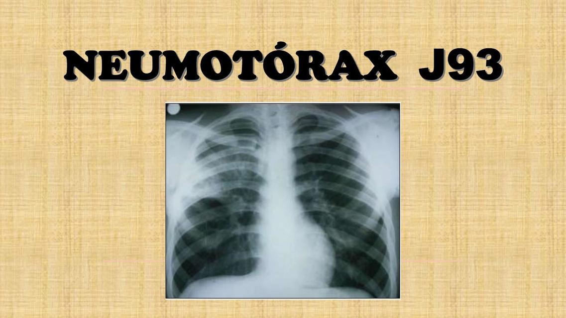 NEUMOTÓRAX | Neumotórax | Salud | uDocz