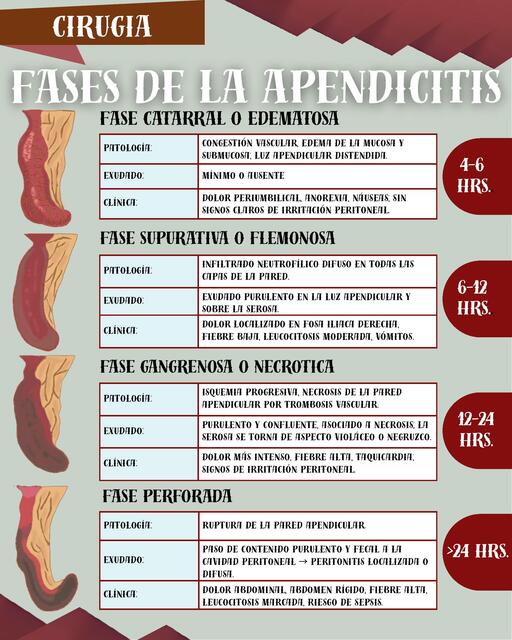 Fases de la apendicitis | Capa Blanca | uDocz